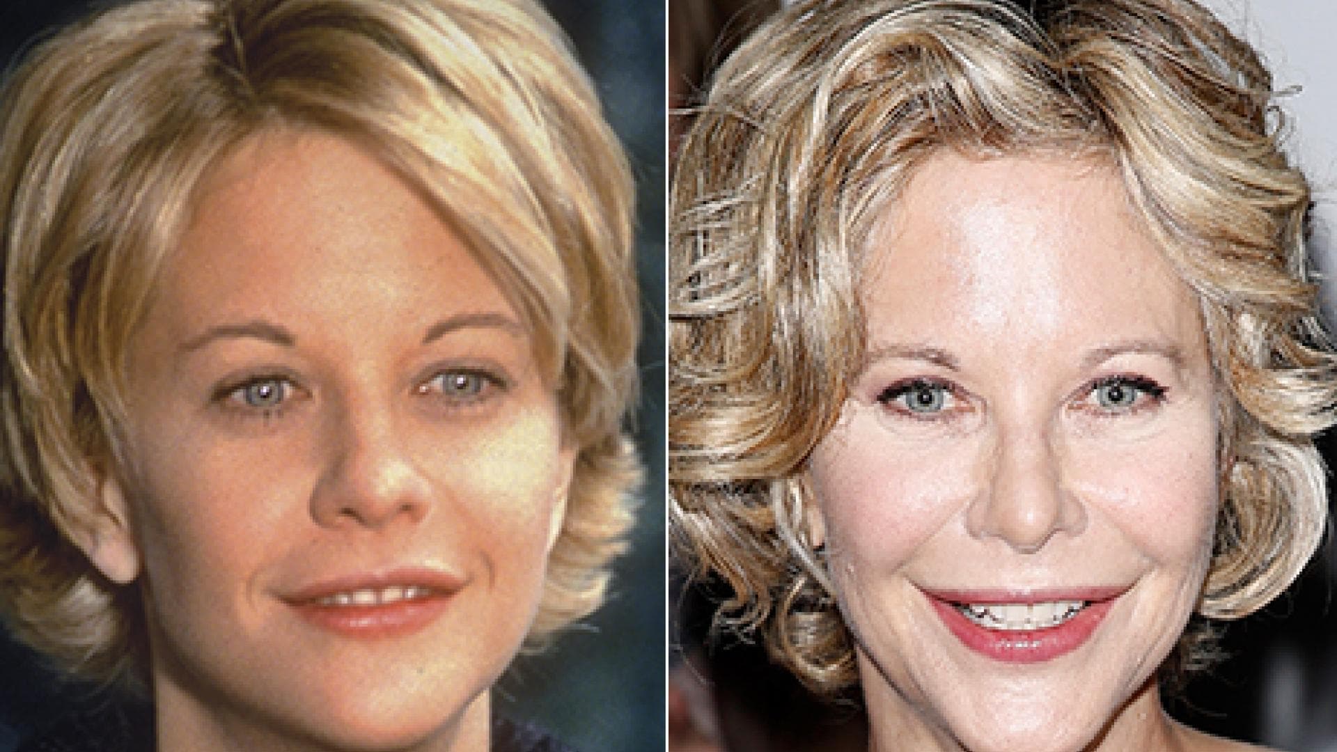 Botox-Panne: Meg Ryan ist kaum wiederzuerkennen!
