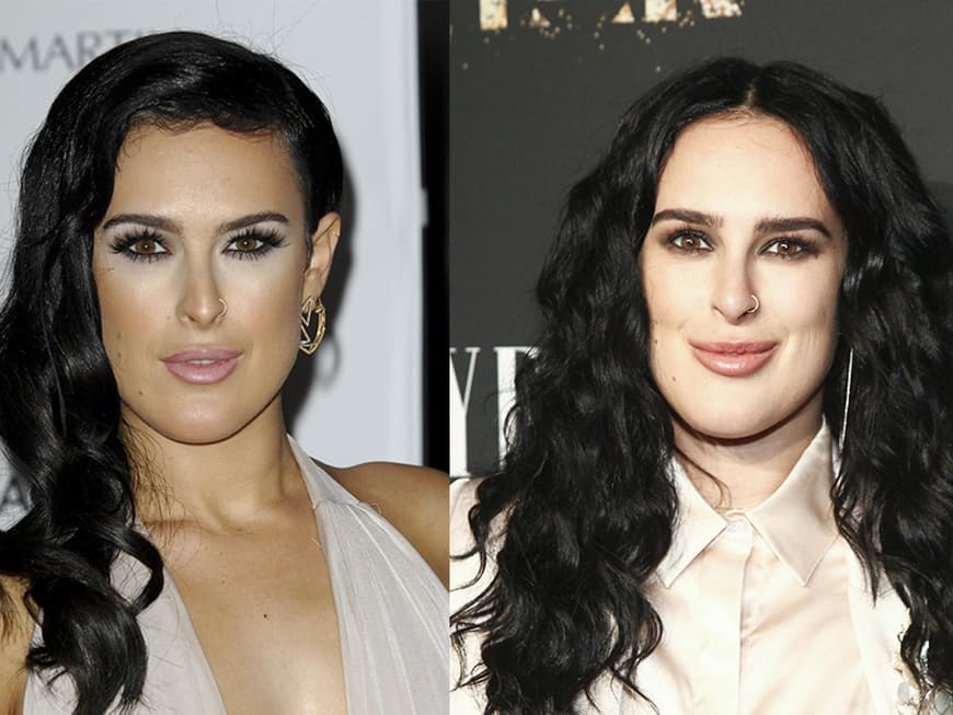 Ein neues Kinn: Hollywoods neuer Schönheitstrend